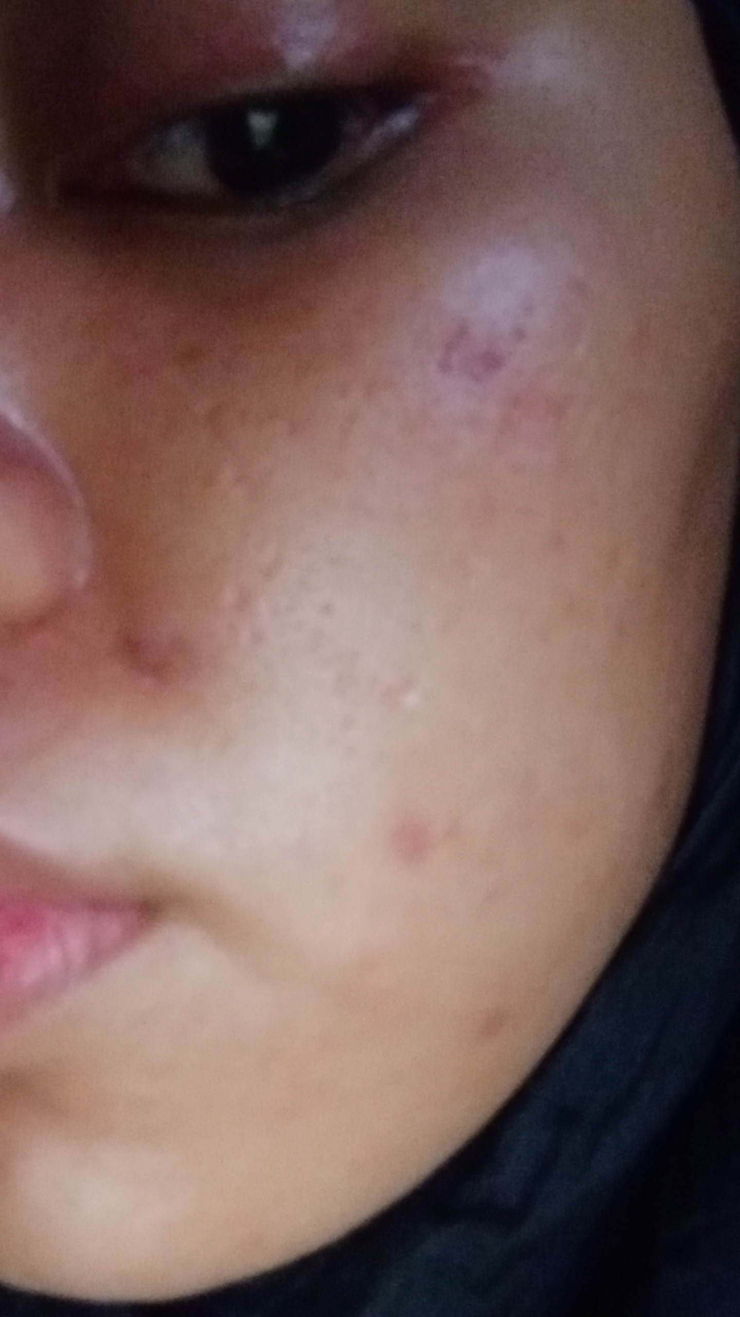 Bopeng Bekas Jerawat: Jenis & Cara Menghilangkan - Heystetik