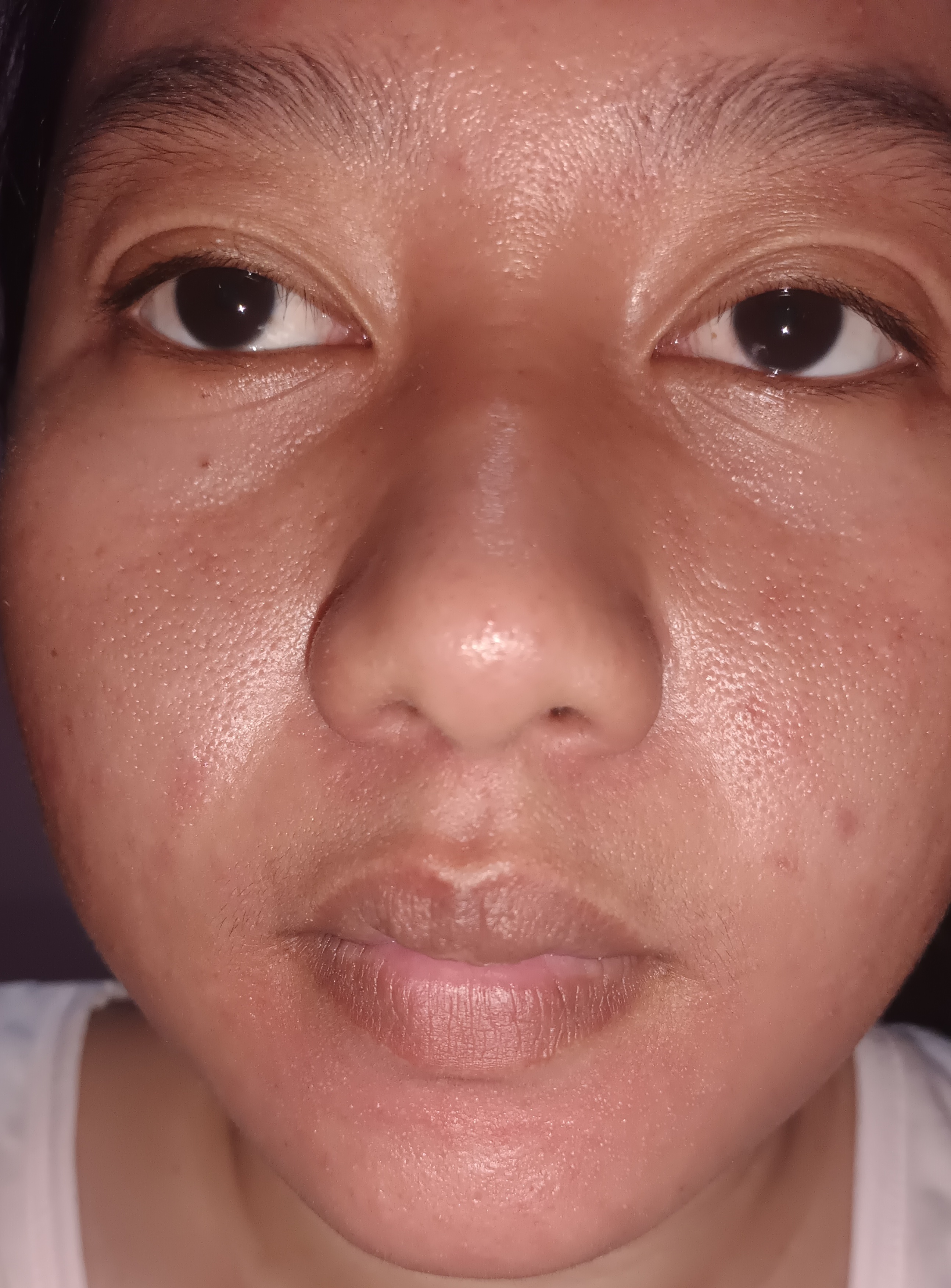 Heystetik - Kulit wajah terdapat kumpulan bruntusan berisi seperti air ...