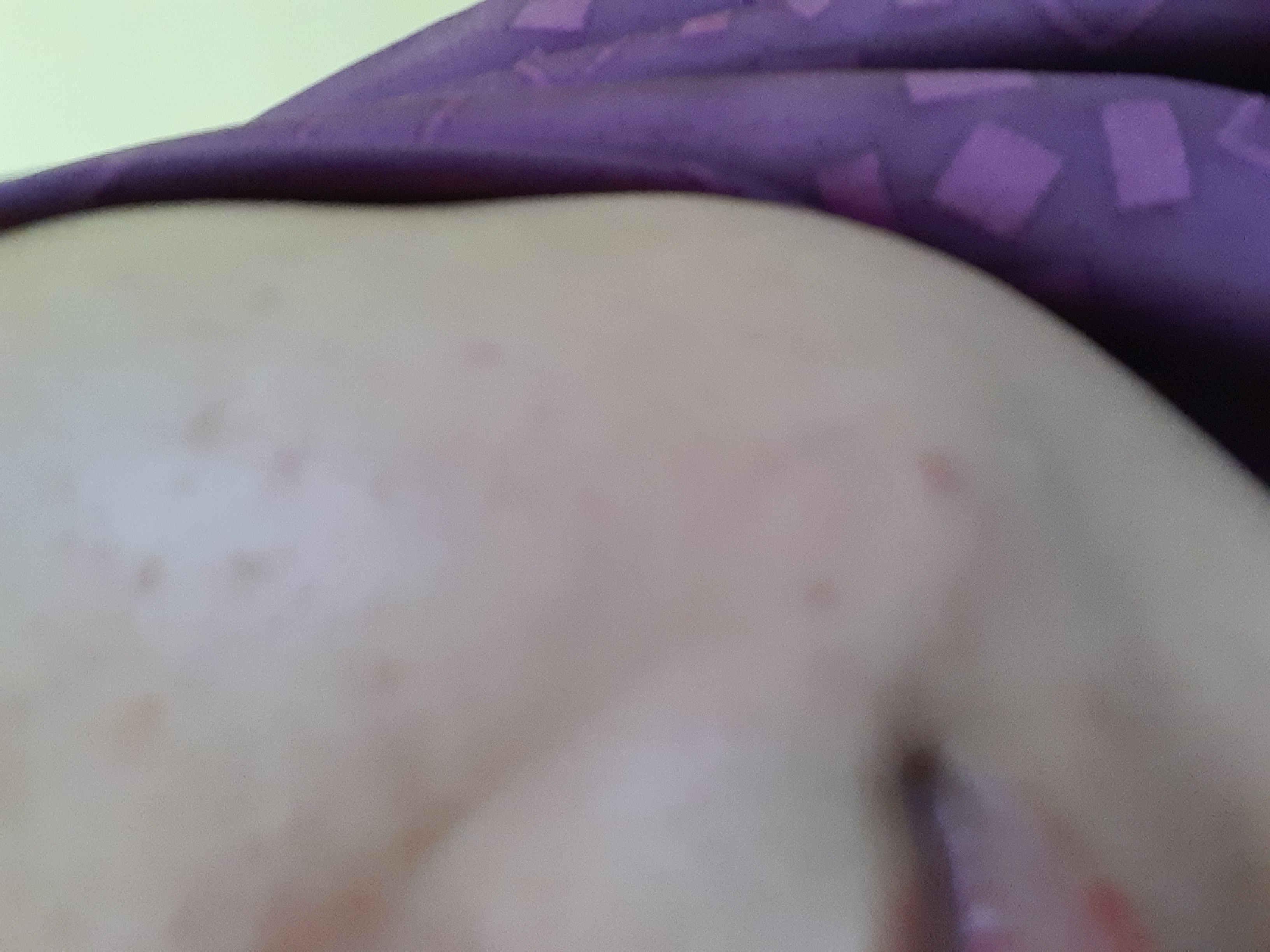 Bopeng Bekas Jerawat: Jenis & Cara Menghilangkan - Heystetik