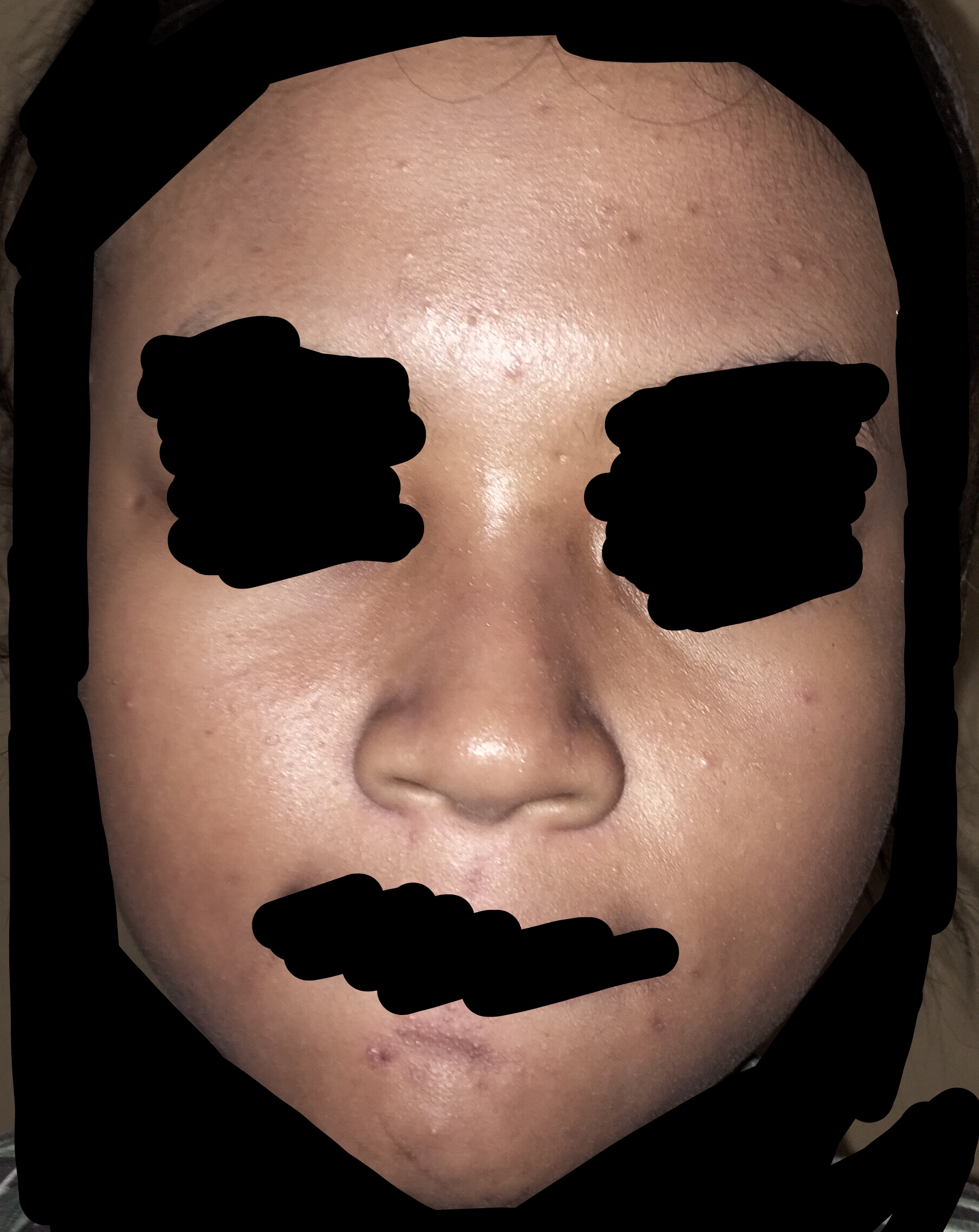 Bopeng Bekas Jerawat: Jenis & Cara Menghilangkan - Heystetik